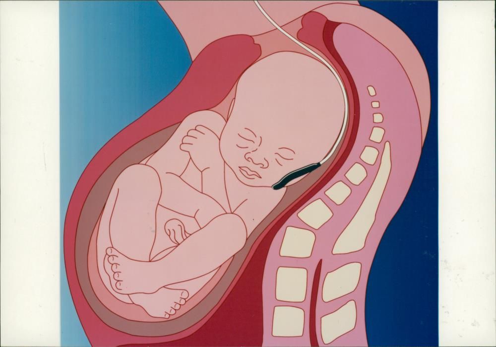 Fetal Pulse Oximetry Sensor in Position. - Vintage Photograph