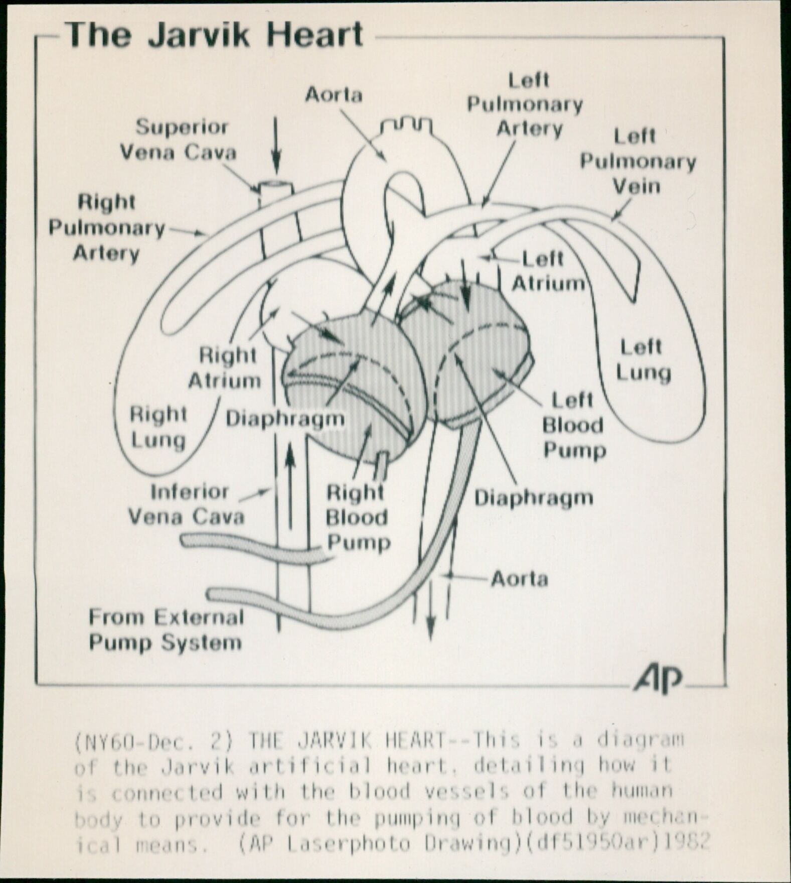 A diagram of the Jarvik artificial heart, detailing how it is connecte